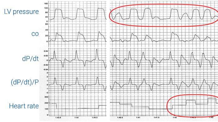 Atrial fibrillation and heart failure